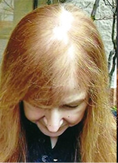 Lisa Hair Success Story - Tricho Labs